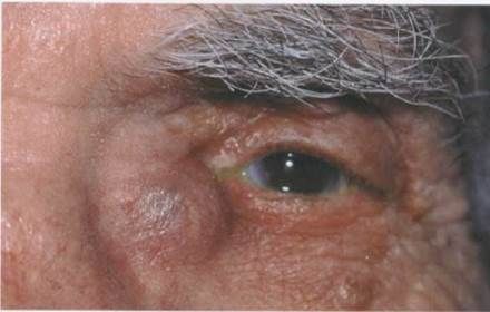 Vía Lagrimal - SOPANOP - Sociedad Panamericana de Oculoplastía